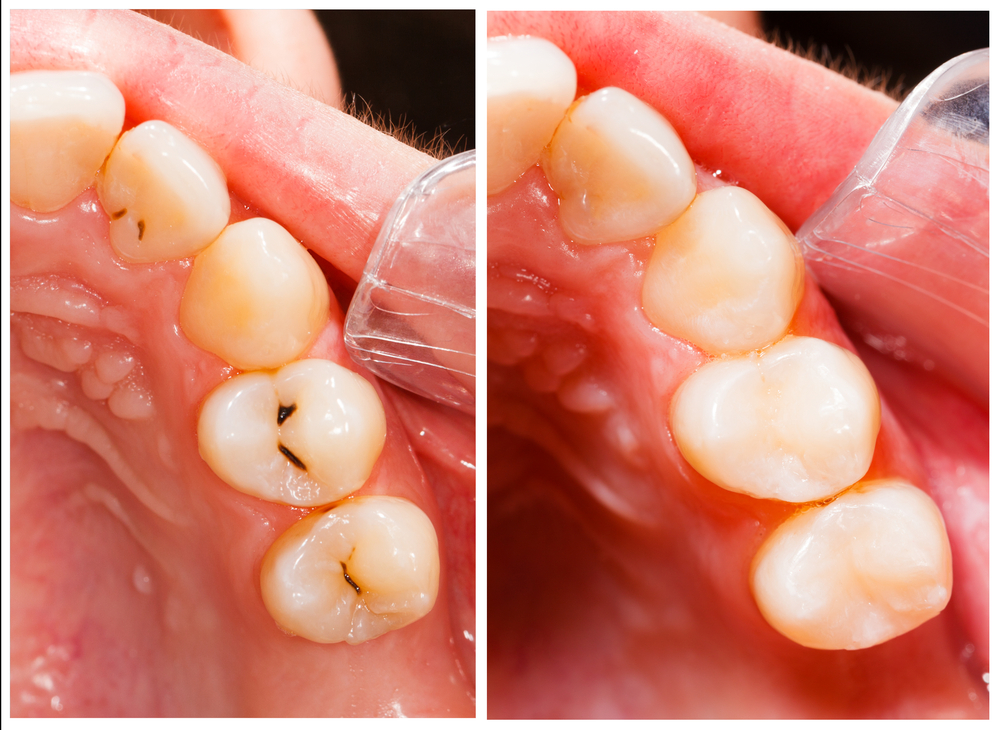 Tooth Colored Fillings For A Beautifully Healthy Smile In Virginia